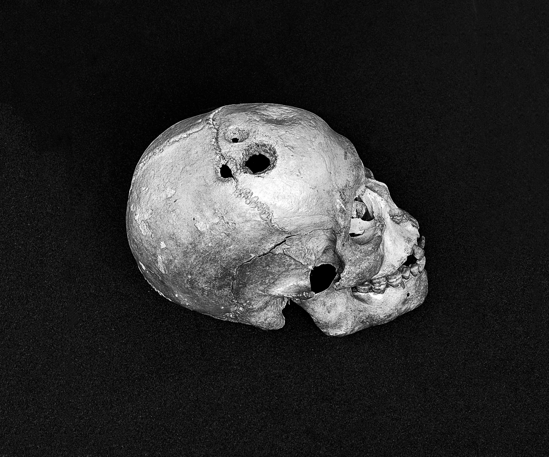 Drilling Deep: How Ancient Chinese Surgeons Opened Skulls and Minds