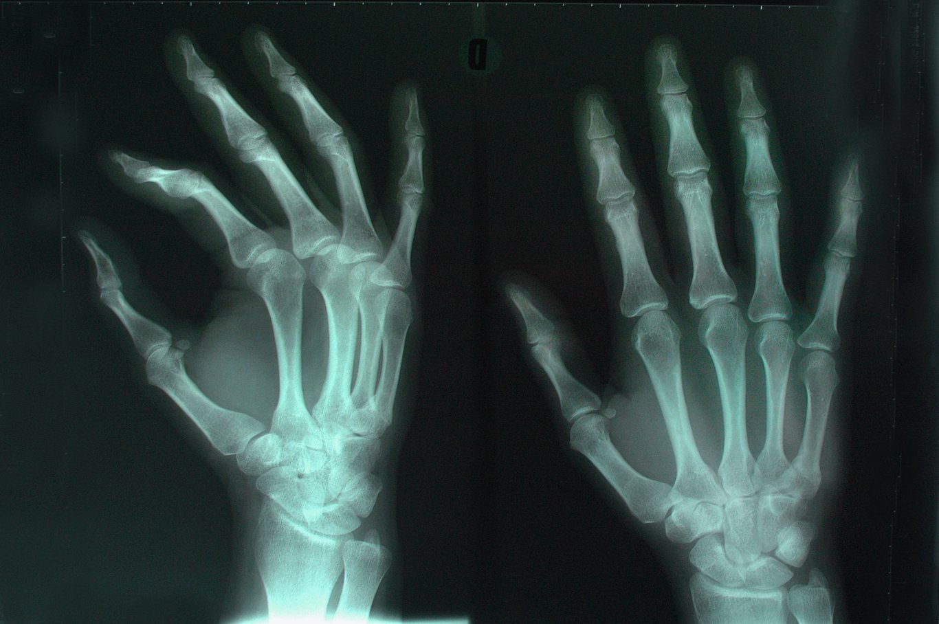 The long and short of bone shapes